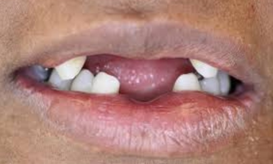 Severely Teeth Treatment in Ranchi, Mutilated Dentition